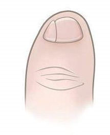 Legends of the Split Pinky Toenail – Stephwaxpoetic